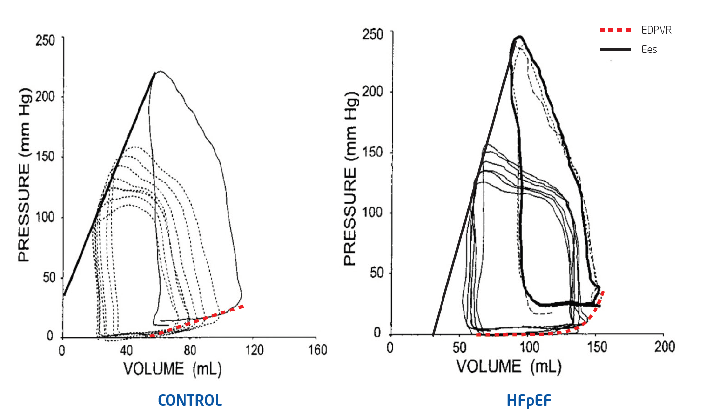 Heart Failure with Preserved Ejection Fraction (HFpEF) - CD Leycom