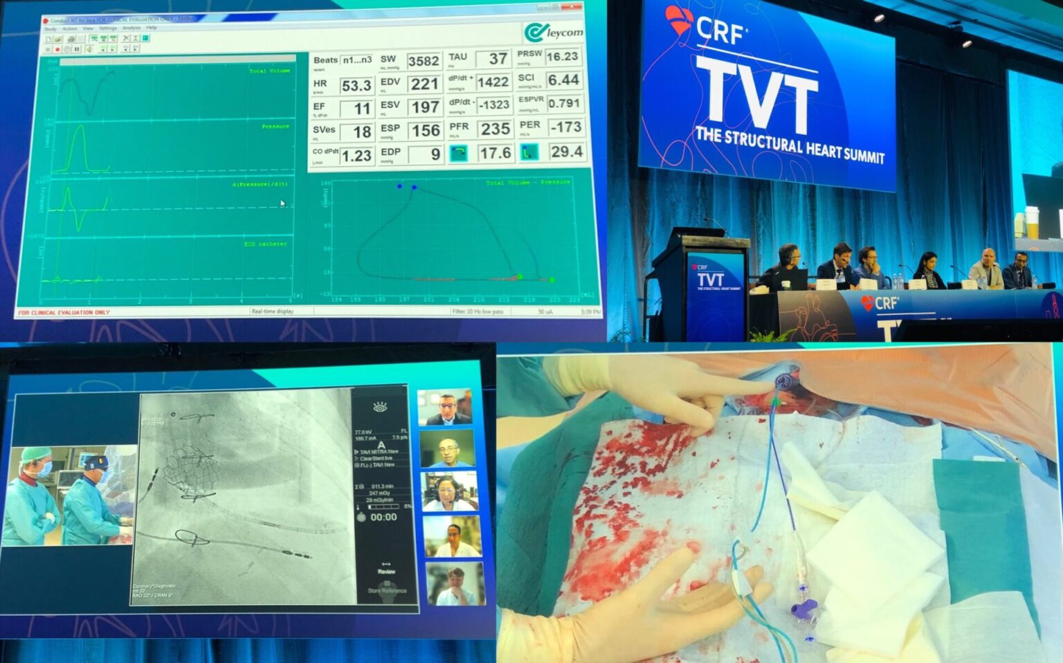 Impact of Preload and Afterload on PV Loops in Heart Failure