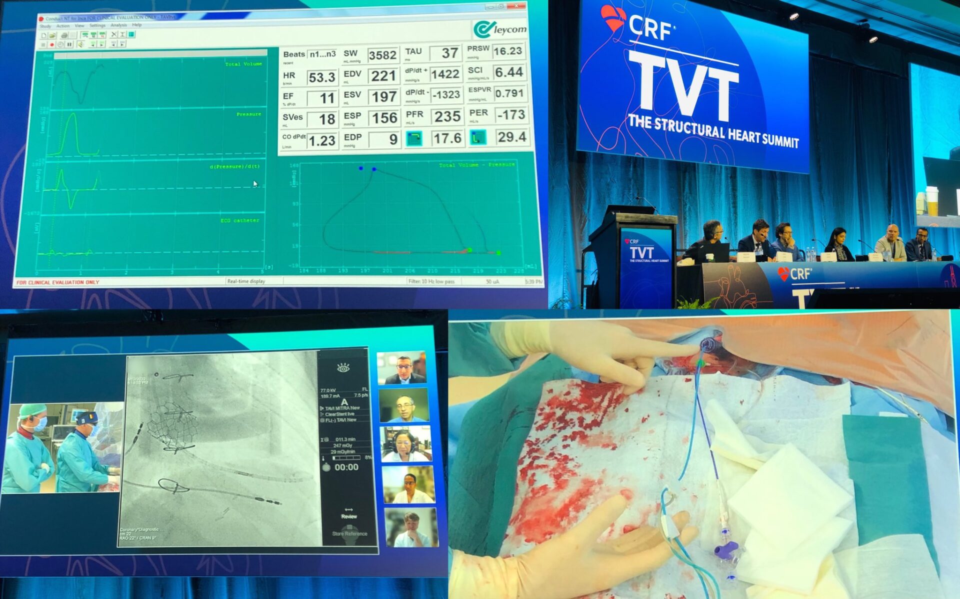 Impact of Preload and Afterload on PV Loops in Heart Failure